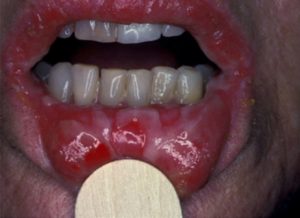 Patologia buzelor în practica dermatologică și cosmetologică – Health ...