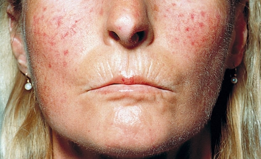 Patologia buzelor în practica dermatologică și cosmetologică – Health ...